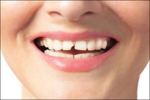 Dealing with Tooth Pain from a Broken or Cracked Tooth - Forest Hills ...